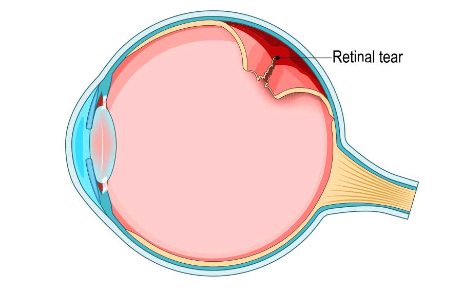 Retina and Vitreous Treatment & Surgery | Retina Center of Vermont