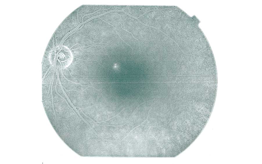 Central Serous Chorioretinopathy | Retina Center of Vermont